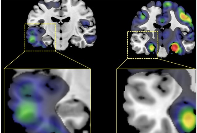 Brain scans suggest subtypes of Alzheimer’s disease | Department of ...
